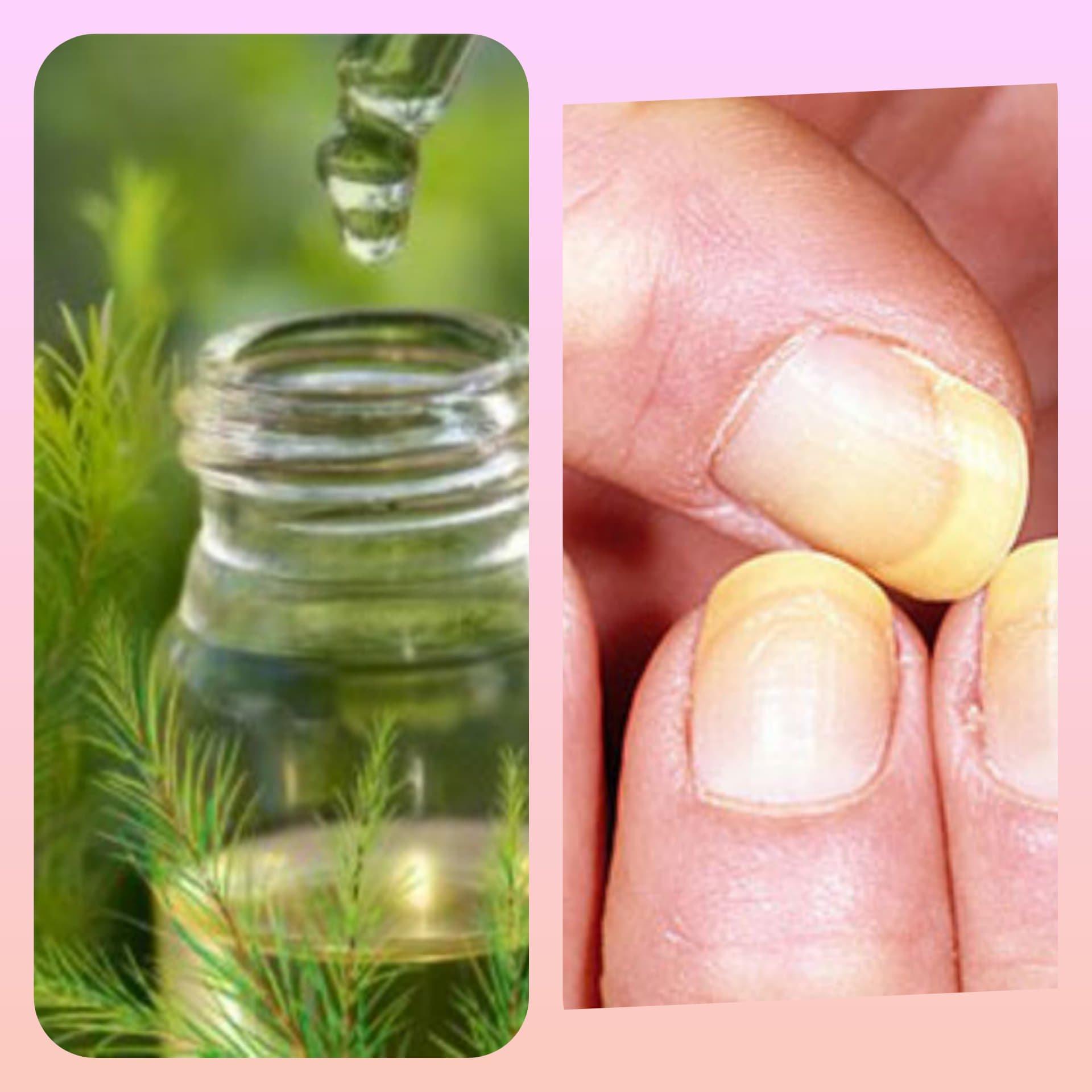 Tất tần tật kiến thức về Tea Tree Oil và tips làm đẹp hữu ích - BlogAnChoi