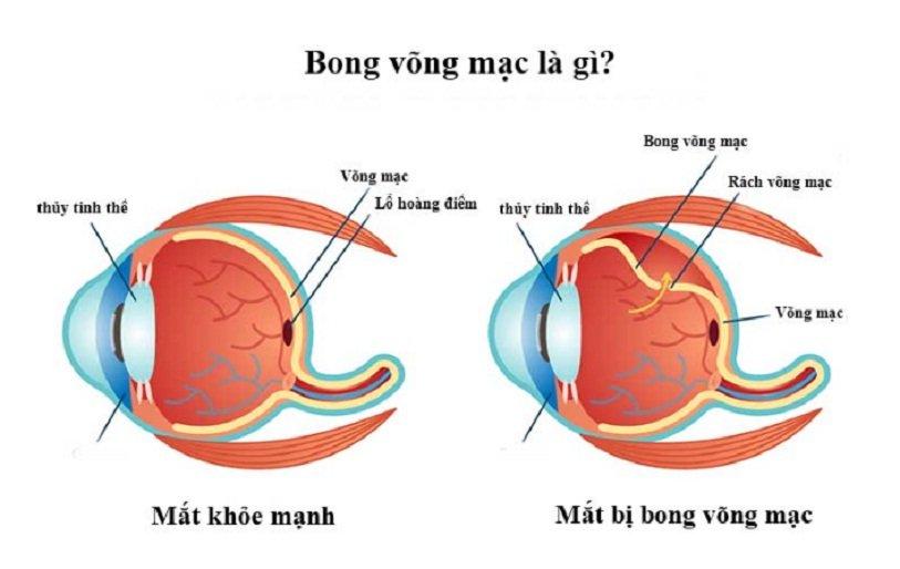 Hiện tượng nổ đom đóm mắt có nguyên nhân do đâu? Liệu có phải là bệnh ...