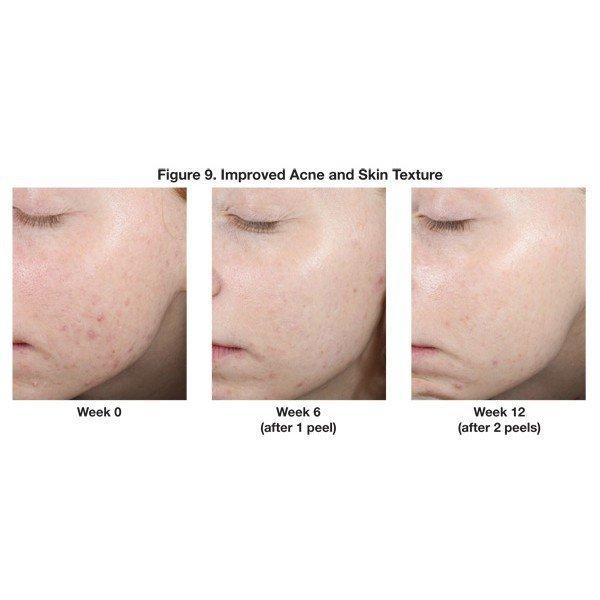 Review Neostrata Prosystem Retinol Peel: tinh chất thay da sinh học ...