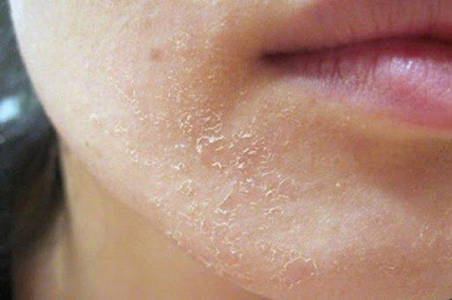 Review Tretinoin Gel USP Aret Menarini: trị mụn, trị thâm hiệu quả ...