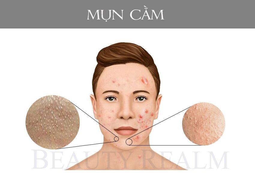 Mụn - vị trí mọc mụn và những thông báo từ bên trong cơ thể - BlogAnChoi